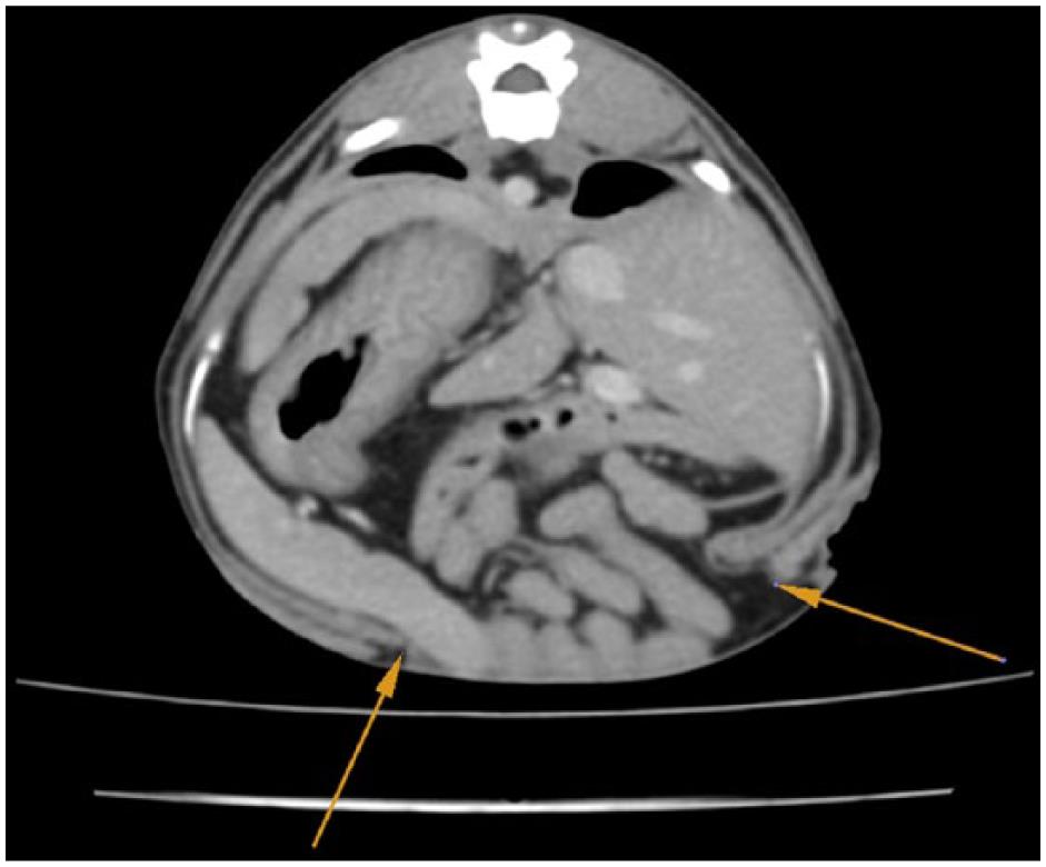 Congenital cranial ventral abdominal hernia, peritoneopericardial ...