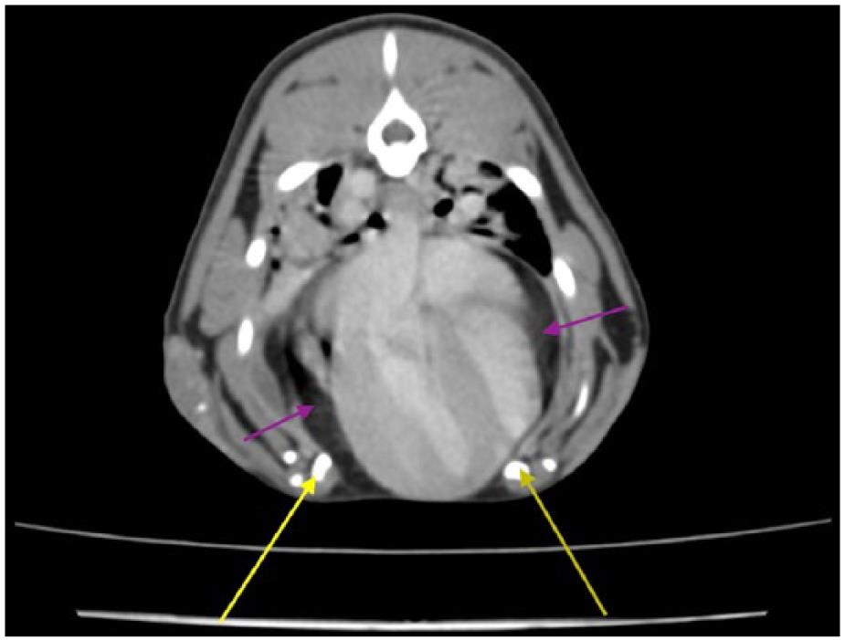 Congenital cranial ventral abdominal hernia, peritoneopericardial ...